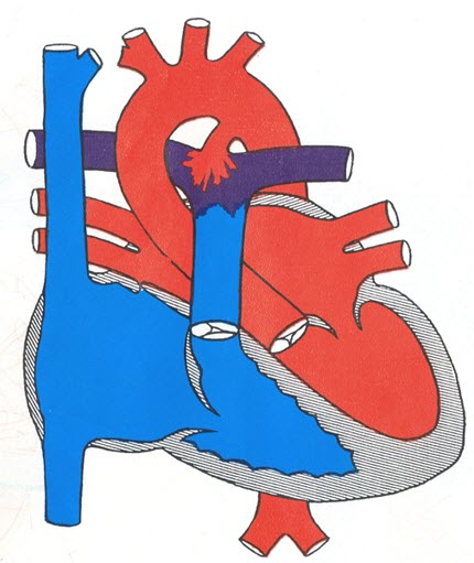 ASD, VSD, PDA Device closure - KIDS HEART FOUNDATION (KHF)