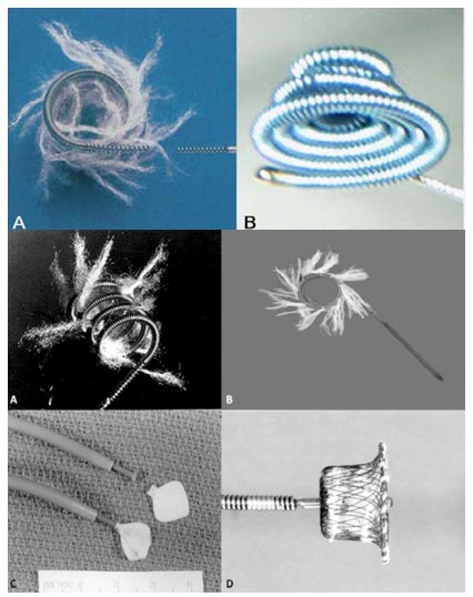 ASD, VSD, PDA Device closure - KIDS HEART FOUNDATION (KHF)