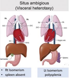 ECHO CARDIOGRAPHY Sequential segmental analysis - KIDS HEART FOUNDATION ...