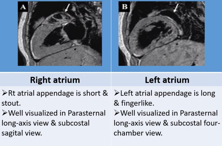 ECHO CARDIOGRAPHY Sequential segmental analysis - KIDS HEART FOUNDATION ...