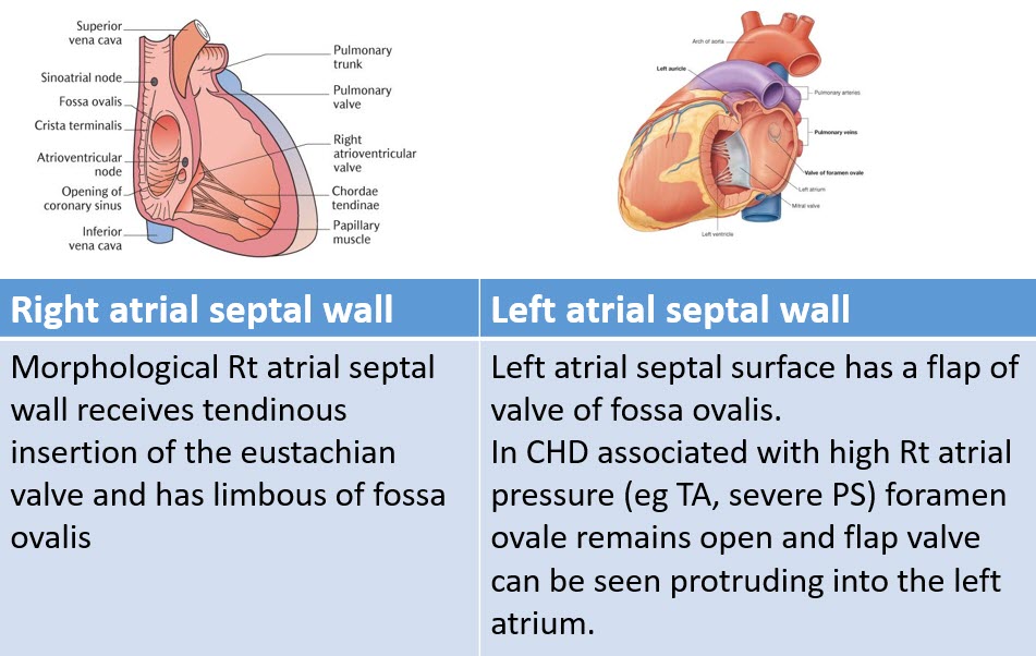 ECHO CARDIOGRAPHY Sequential segmental analysis - KIDS HEART FOUNDATION ...