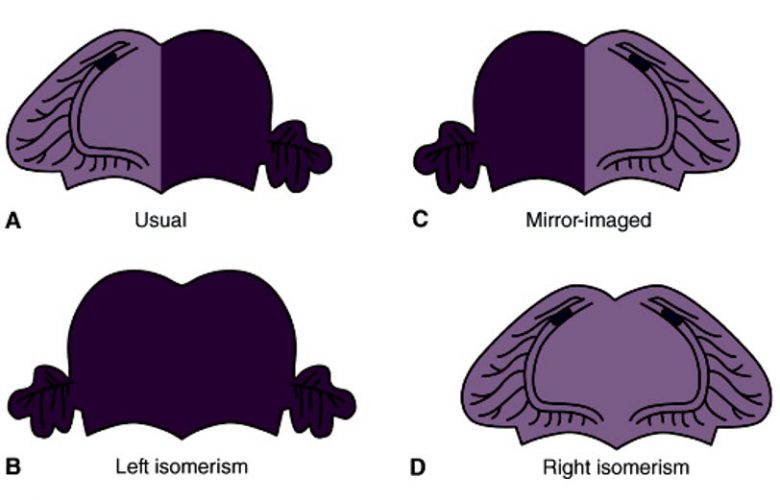 ECHO CARDIOGRAPHY Sequential segmental analysis - KIDS HEART FOUNDATION ...