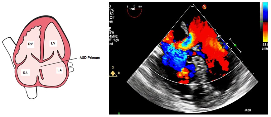 ECHO CARDIOGRAPHY Sequential segmental analysis - KIDS HEART FOUNDATION ...