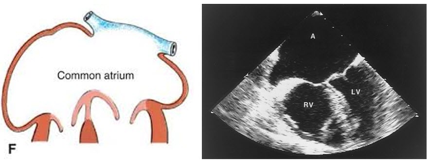 ECHO CARDIOGRAPHY Sequential segmental analysis - KIDS HEART FOUNDATION ...