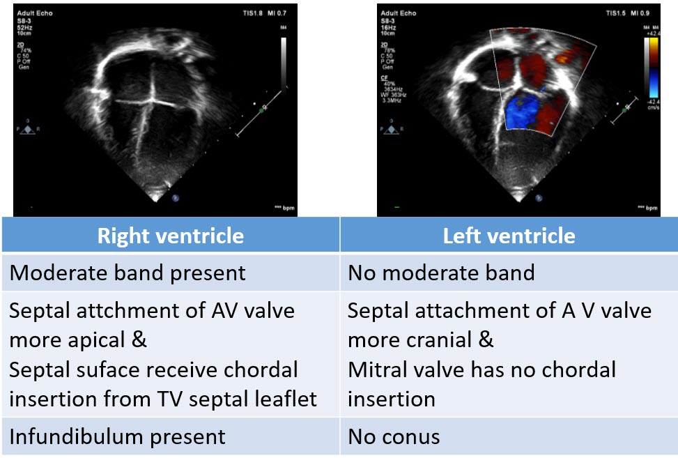 ECHO CARDIOGRAPHY Sequential segmental analysis - KIDS HEART FOUNDATION ...