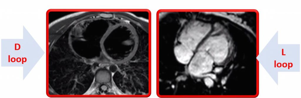 ECHO CARDIOGRAPHY Sequential segmental analysis - KIDS HEART FOUNDATION ...